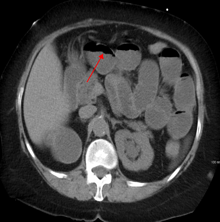 Occlusion intestinale : symptômes, diagnostic, traitement | Dr Y. Nijs Occlusion intestinale : symptômes, diagnostic, traitement | Dr Y. Nijs